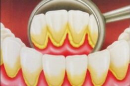 Tártaro e suas implicações na saúde do paciente,Clinil Odontologia.